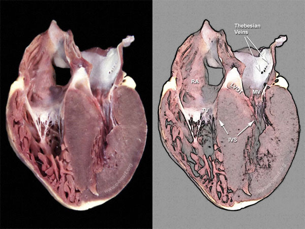 e-heart.org Cardiovascular Pathology Home Page