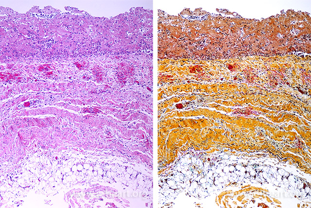 e-heart.org Cardiovascular Pathology Home Page