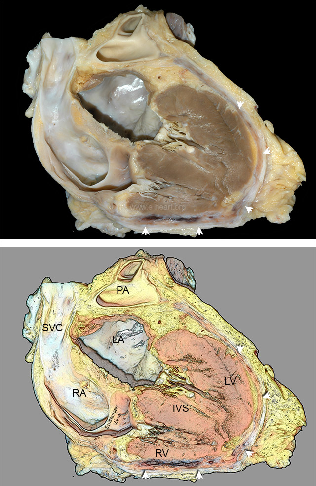 e-heart.org Cardiovascular Pathology Home Page