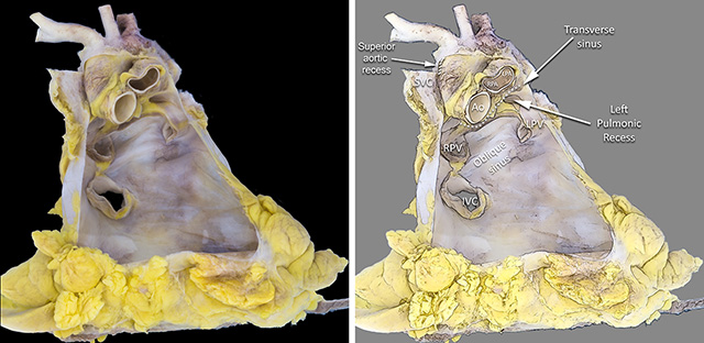 Transverse Pericardial Sinus