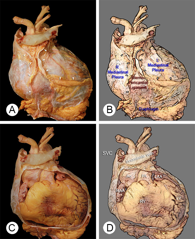 e-heart.org Cardiovascular Pathology Home Page
